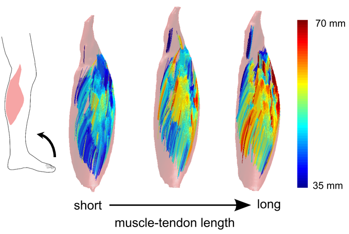 World’s first longitudinal muscle study grows understanding of cerebral ...
