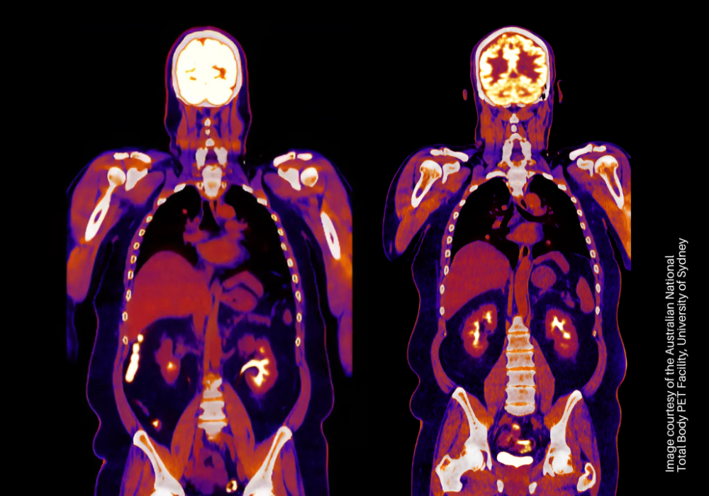 Australian National Total Body PET: Webinar series - National Imaging ...